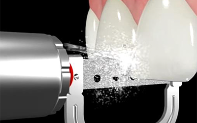 Modul 6: Attachments, IPR, Refinements – Digital Ortho Academy